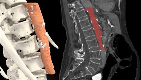 Calcification Plaque Measurement In Aorta Download Scientific Diagram
