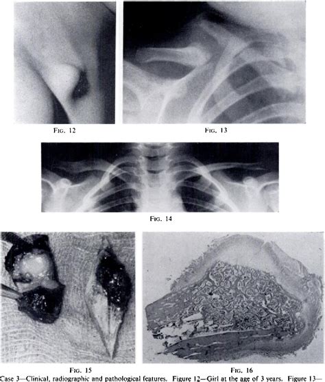 Figure 1 From Congenital Pseudarthrosis Of The Clavicle Semantic Scholar
