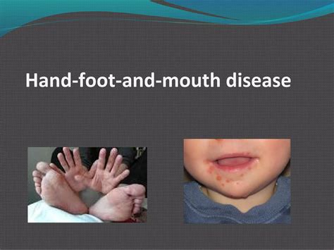 Hand Foot And Mouth Disease HFMD RIS Clinic PPT