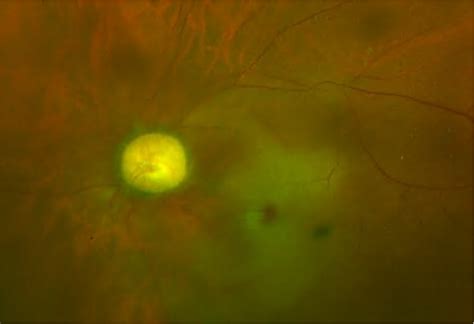 Retinal Artery Occlusion Viewpoint