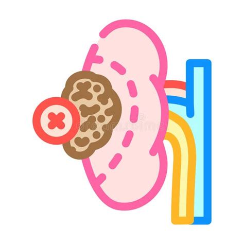 Nephrectomy Surgery Color Icon Vector Illustration Stock Vector