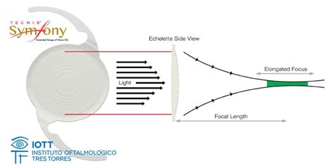 Conoce La Lente Intraocular De Ltima Generaci N Tecnis Symfony Iott