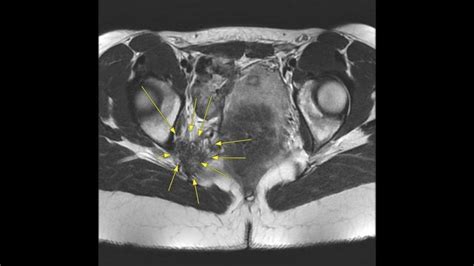 Excision Of Large Sciatic Nerve Nodule Onset Of The Procedure