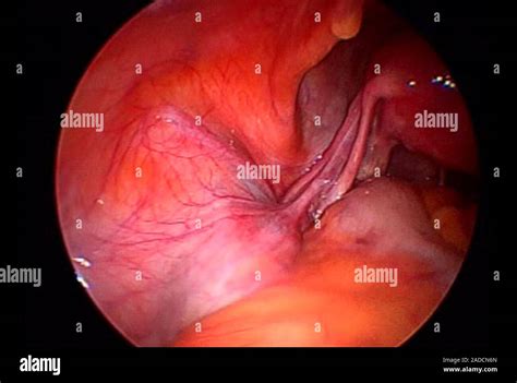 Two Round Ligament Of Uterus Epos™