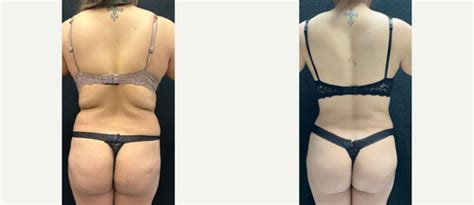 Lymphatic Drainage Hands Of The State Massage