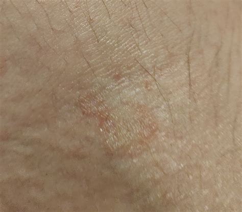 What Do You Think This Is Appeared On My Arm A Few Days Ago Skincancer