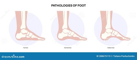 Foot Pathologies Poster Stock Vector Illustration Of Vector 288675119