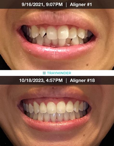 Finally Done After 25yrs Rinvisalign
