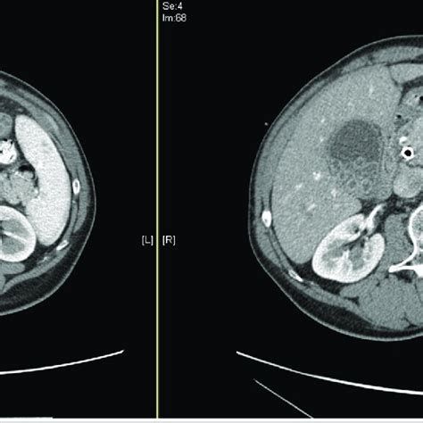 Abdominal Ct Scan Multiple Cholelithiasis With Acute Cholecystitis Download Scientific Diagram