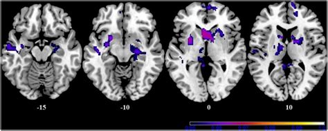Resting State Brain And The Fto Obesity Risk Allele Default Mode Sensorimotor And Salience