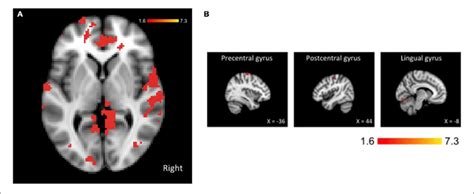 Brain Activation For The Dual Task Single Task Contrast Showing