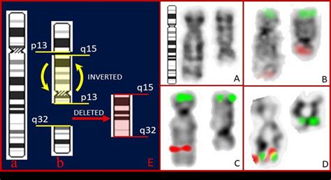 5q Inversion And Deletion A G Banded Normal Chromosome 5 And