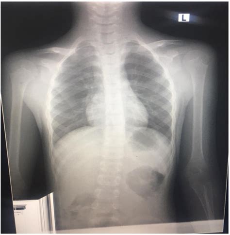 A Clear Chest X Ray Post Removal Of The Metallic Foreign Body