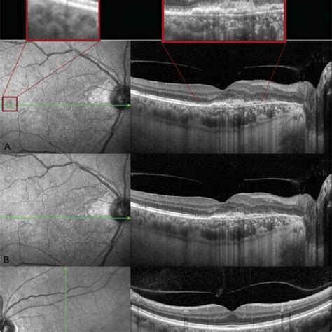 the sd oct through the central macula reveals disruptions of the inner