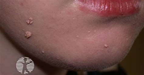 Viral Warts Image