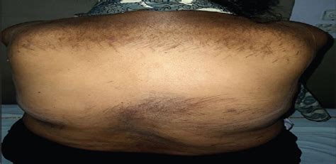 Ribociclib Induced Flagellate Rash Cancer Research Statistics And Treatment