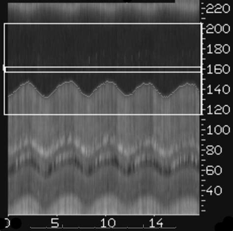 Navigator Echoes Questions And Answers In Mri