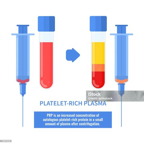 Platelet Rich Plasma Therapy Procedure Infographics Poster Stock Illustration Download Image