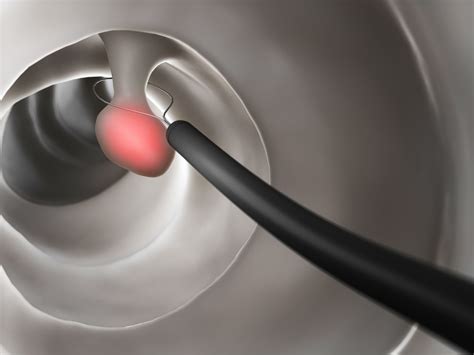 C Mo Se Diagnostica La Enfermedad Diverticular Medicina B Sica
