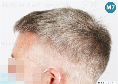 Dr Jean Devroye Hts Clinic 2052 Fue Hairline Restoration