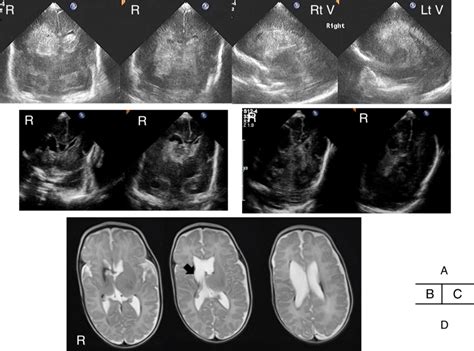 Case 2 Intraventricular Hemorrhage Ivh Grade Iv Occurring On Day 3