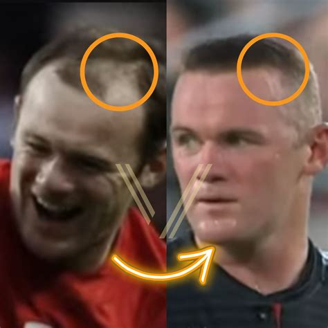 Wayne Rooneys Hair Transplant Before And After Transformation
