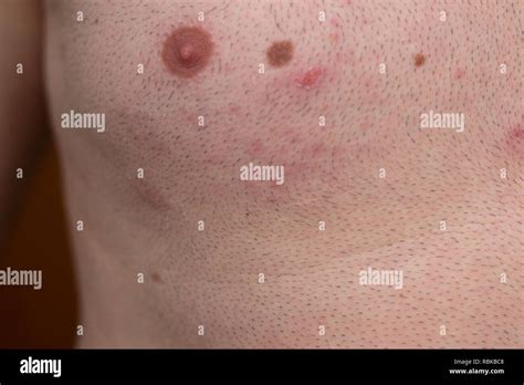 Herpes zoster Banque de photographies et dimages à haute résolution
