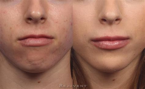 Non Surgical Chin Augmentation Rejuvent Scottsdale