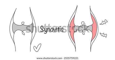 52 Imágenes Fotos De Stock Objetos En 3d Y Vectores Sobre Synovial