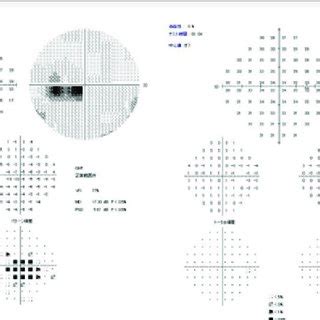 OCT Scanning Visual Field Report Of Three Typical Patients The Central Download Scientific