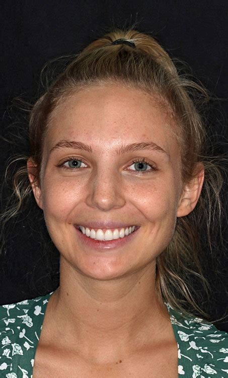How Many Porcelain Veneers Do I Need