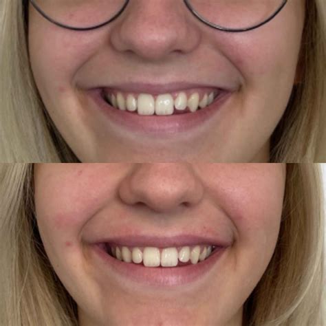 Gallery Before And After Med Spa Photos Lacey WA