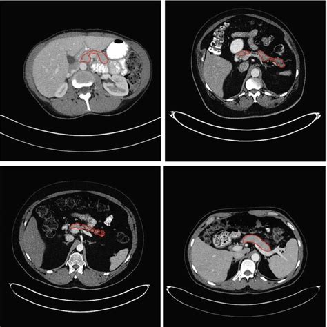 iterative 3d feature enhancement network for pancreas segmentation from