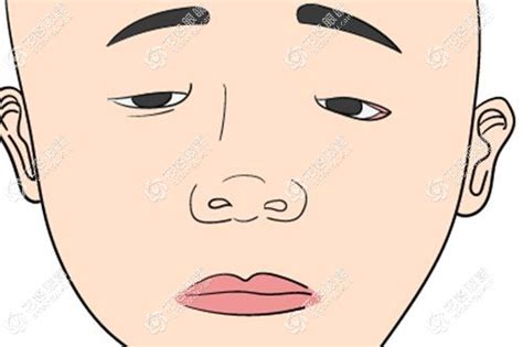 小睑裂 小睑裂综合征原因 小睑裂综合征手术费用 小睑裂综合症是什么 花容眼睛