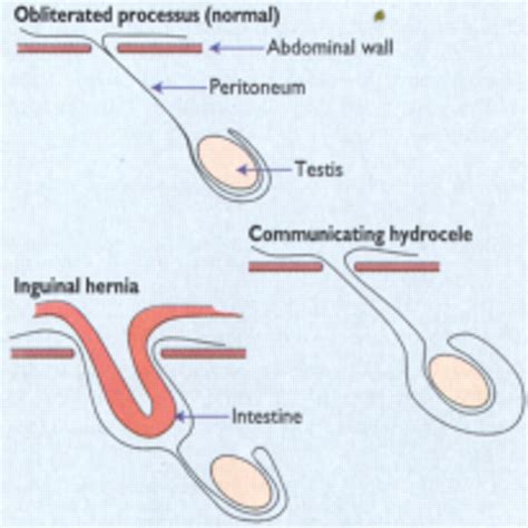 Abc Of General Paediatric Surgery Inguinal Hernia Hydrocele And The Undescended Testis The Bmj
