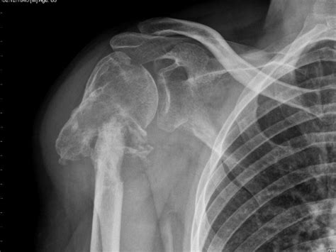 Proximal Humerus Fractures Trauma Orthobullets Com
