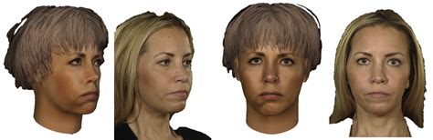 Three Dimensional Soft Tissue Simulation In Orthognathic Surgery Atlas Of The Oral And