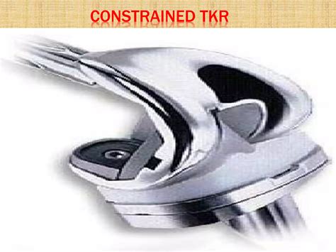 Total Knee Replacement Tkr Ppt