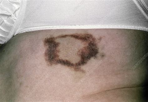 Bruised Rib Symptoms And Causes