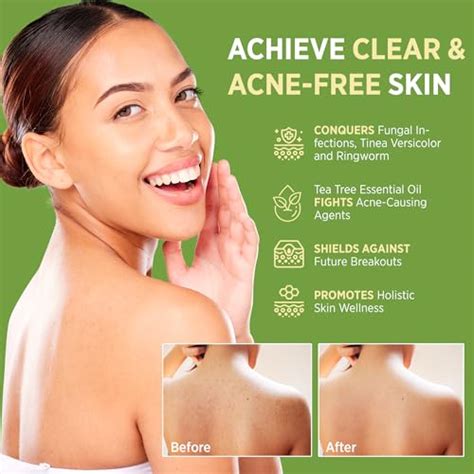 Mua Roycederm Antifungal Antibacterial Tea Tree Soap Antifungal