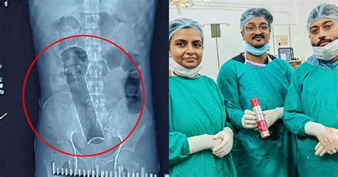 Man Shoved 8 Inch Can Up His Butt And Left It There For 3 Weeks
