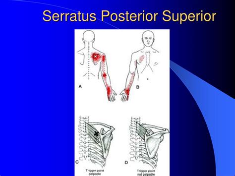 Serratus Posterior Superior Trigger Point