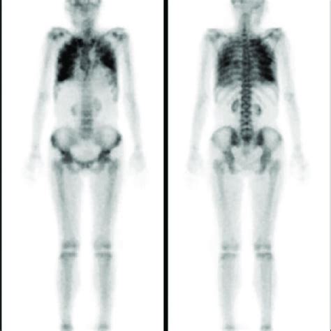 Whole Body Bone Scan With 99m Tc Methylene Diphosphonate Showing