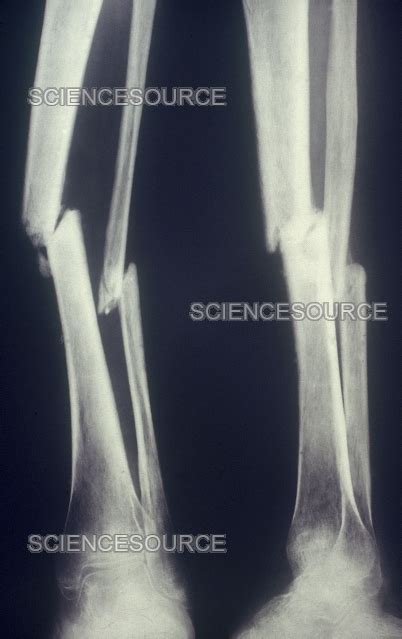 Broken Leg X Ray Stock Image Science Source Images
