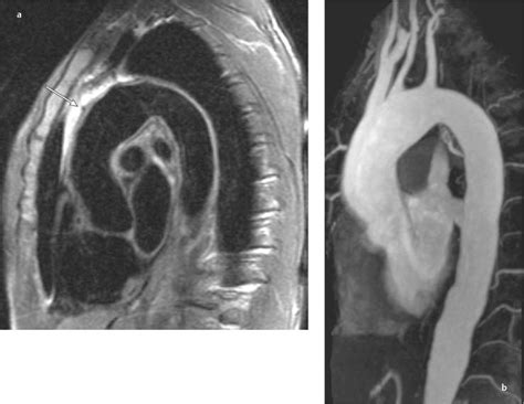 Diseases Of The Thoracic Aorta Radiology Key