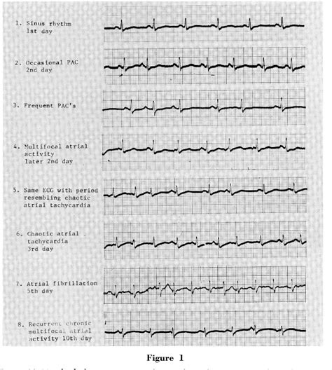 Atrial Rhythm