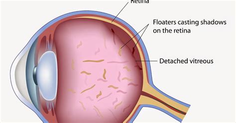 Eye Floaters Review How To Remove Eye Floaters Vitamins For Eye Floater
