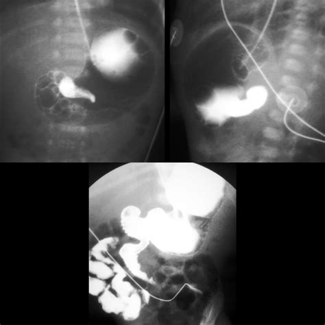 Newborn With Bilious Vomiting Pediatric Radiology Case Pediatric