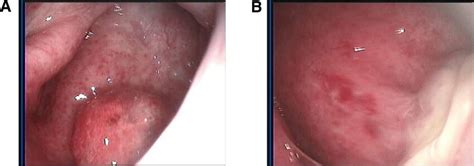 A Nasal Endoscopy Identified A Pedunculated Polypoid Mass With A Download Scientific Diagram