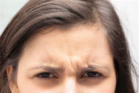 Frown Lines Treatment San Diego County Htb Aesthetics